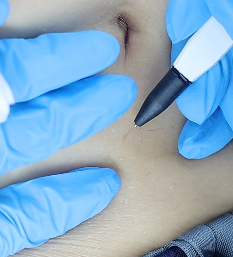 Electrolysis - Permanent Hair Removal - Skin Lounge Aesthetics